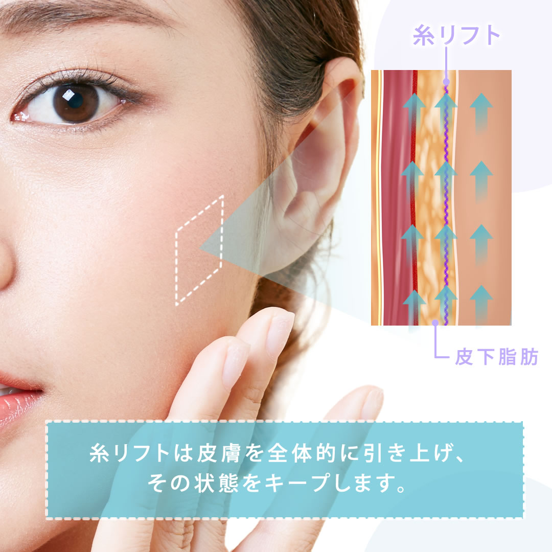 糸リフト(スレッドリフト)のPDO・PCL・PLAって何？素材ごとに違いはあるの？｜金沢の美容外科はeクリニック