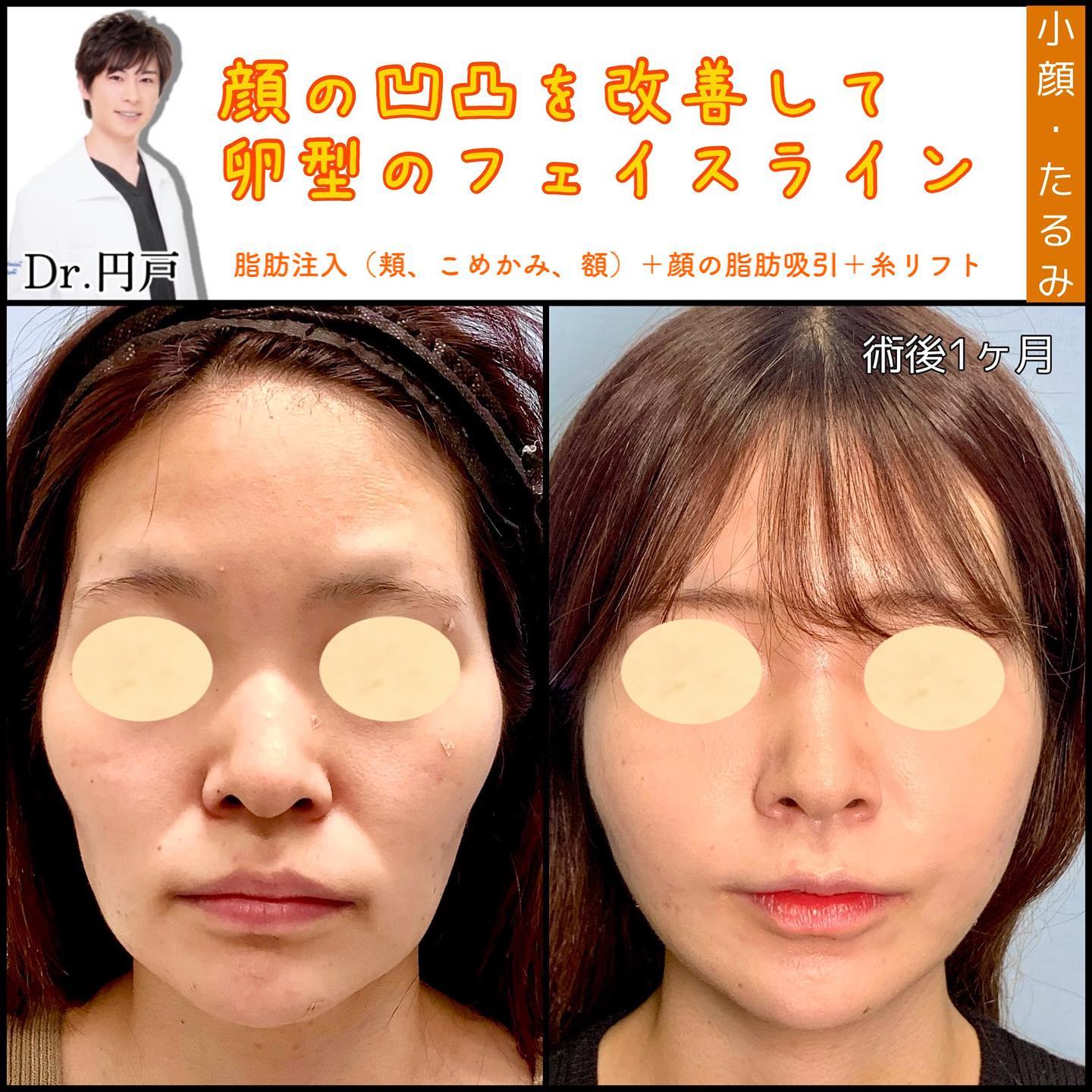 糸リフト(スレッドリフト)のPDO・PCL・PLAって何？素材ごとに違いはあるの？｜金沢の美容外科はeクリニック